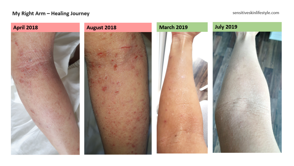 My On-going Recovery Journey Part I – Lifestyle Changes – sensitive ...